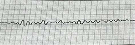 A P II Final Exam Flashcards Quizlet