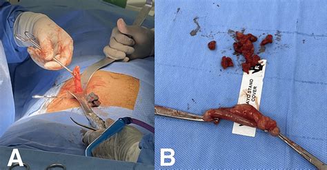 Acute Appendicitis In Cureus Double Appendix A Case Report Acute Appendicitis Is One Of The