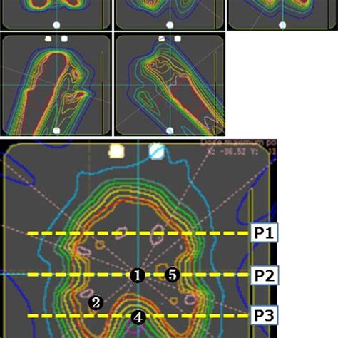 Measurement Points And Dose Distributions Of Each Field And Accumulated