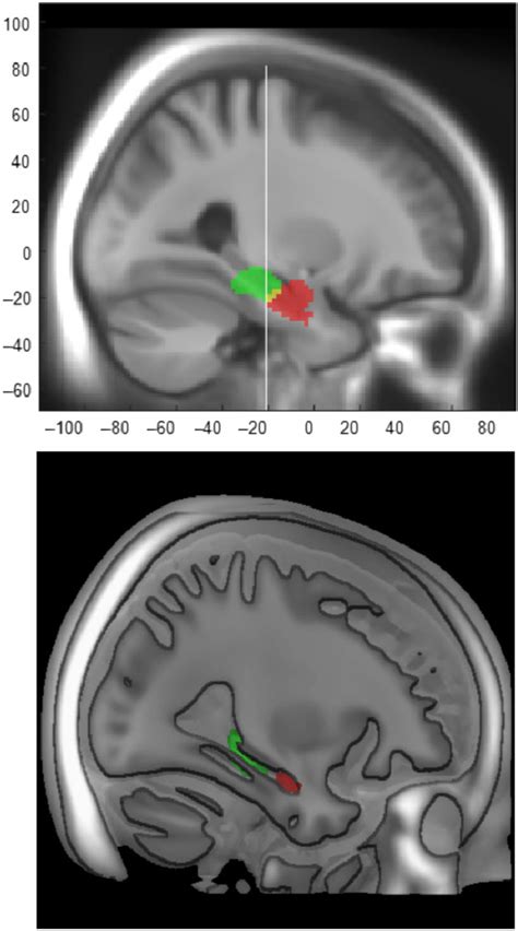 Two Resting State Ica Components Along The Longitudinal Download Scientific Diagram