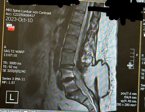 Ab Exercises R Spinalfusion