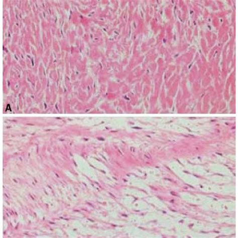 A B Photomicrographs Show A Hypocellular Fibroblastic Proliferation