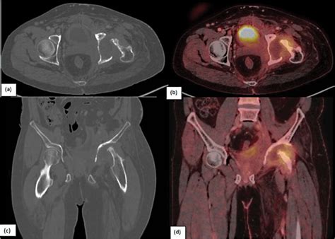 Pet Ct Images Ct Axial Bone Window Pet Ct Axial Fusion Image