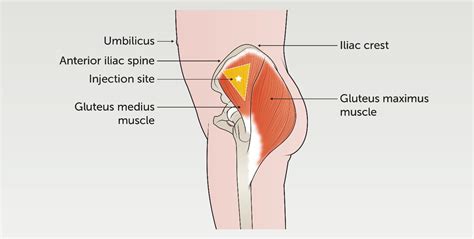 Three Intramuscular Injection Sites