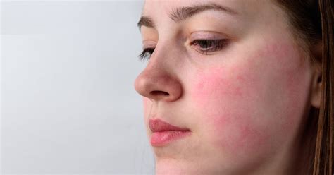 Psoriasis On Face Symptoms Causes And Treatment