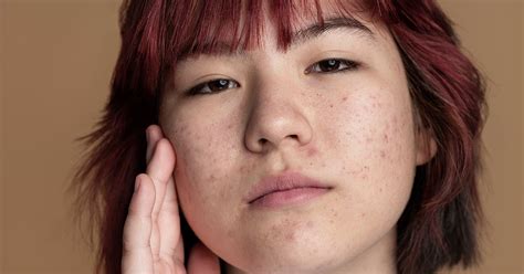 Skin Pigmentation Everything You Need To Know