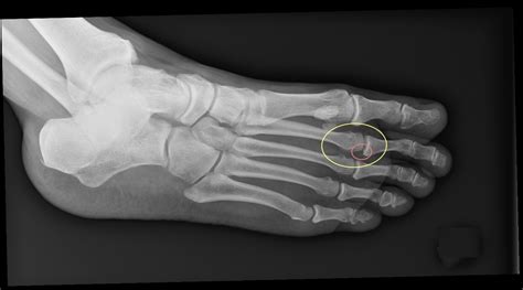 38 Facts About Phalanges