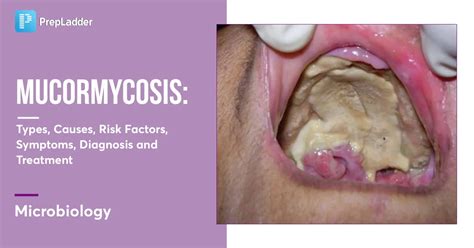 Mucor In Mouth Mucor In Mouth