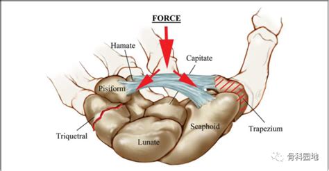 从损伤机制、分型再认识大多角骨骨折 好医术文章 好医术 赋能医生守护生命