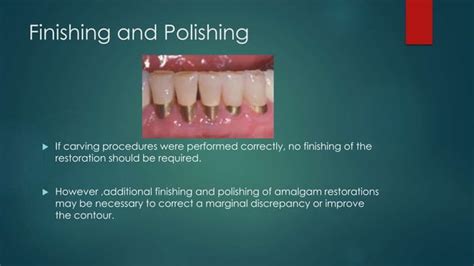 Class V Tooth Preparation For Amalgam Restorations Pptx