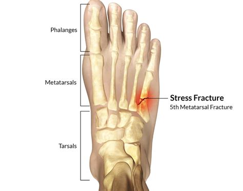 Stress Fracture Examples Stress Fractures Ngthwr