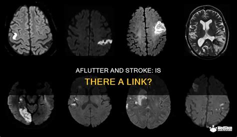 Aflutter And Stroke Is There A Link Medshun Aflutter And Stroke Is There A Link Medshun