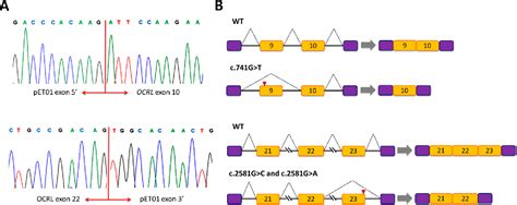 Figure 3 From Splicing Analysis Of Exonic Ocrl Mutations Causing Lowe
