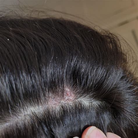 Itchy Scalp Rashlesions Rdermatology