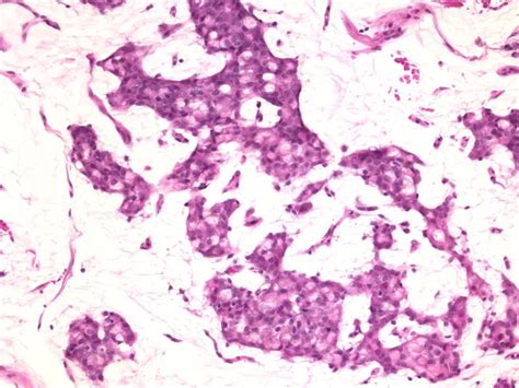 Mucinous Carcinoma Of Breast