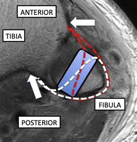 Proximal Tibiofibular Joint Ptfj Reconstruction Suture Loop Schematic Download Scientific