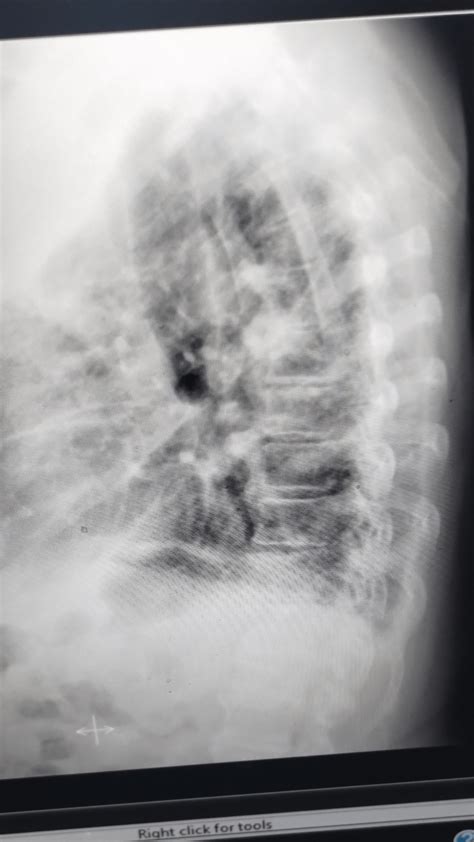 Fluorospot Compact Fd Chest Xray R Radiology