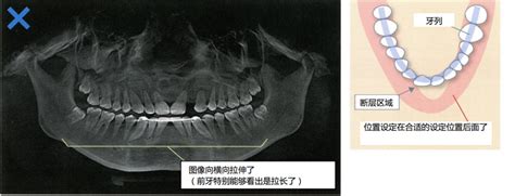正常牙齿侧面图x光片 正常牙齿咬合侧面图 正常左手光片图片 大山谷图库