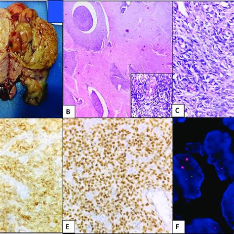 High Grade Endometrial Stromal Sarcoma A Gross Photo Polypoidal Download Scientific Diagram