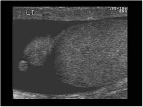 Urinary Tract And Male Reproductive System 2 3 Scrotum Case 2 3 1 Appendages And