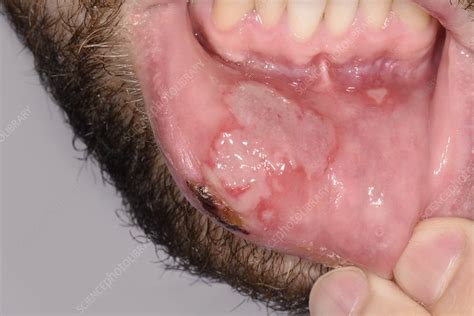 Aphthous Ulcer Stock Image C0532484 Science Photo Library