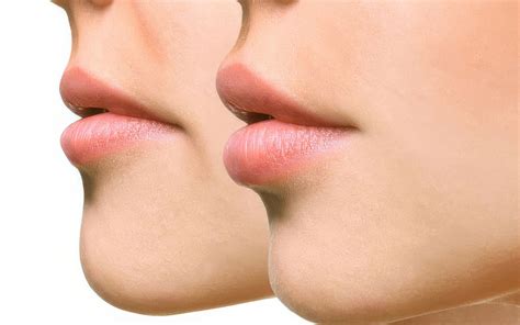 Dermal Fillers Hammersmith Dental Care