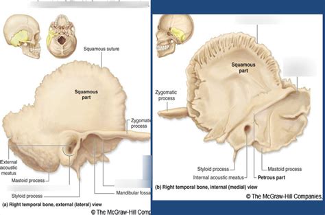 Internal Acoustic Meatus Temporal Bone