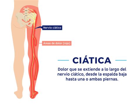 ¿qué Es La Ciática Y Por Qué Da