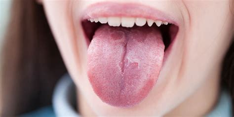 Angular Cheilitis Causes Symptoms Treatment And Prevention