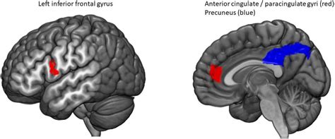 Borderline Personality Disorder Brain Abnormalities