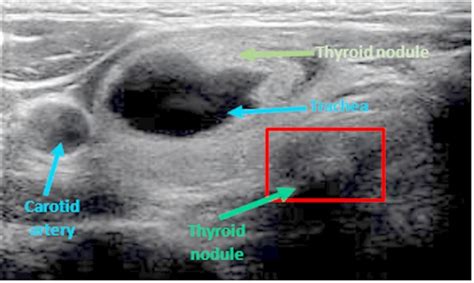 Automated Thyroid Nodule Classification In Ultrasound Imaging Using A