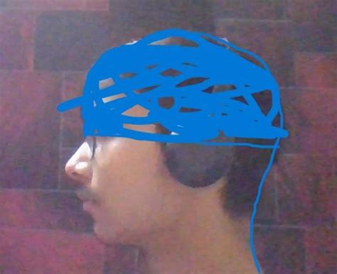 Recessed Or Overbite Forcefull Teeth Alignment In Second One R