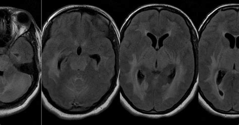 Dr Balaji Anvekar Frcr Japanese Encephalitis Mri