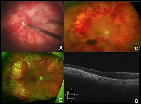 Complete And Early Vitrectomy For Endophthalmitis After Cataract Surge