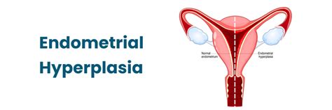 Endometrial Hyperplasia What Women Should Know About This Condition