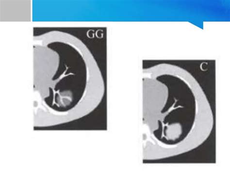 Pulmonary Nodule Pptx