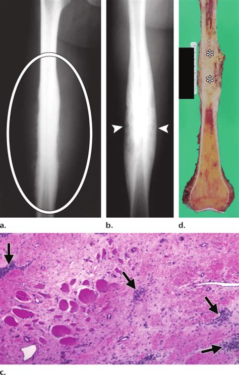 Radiographic Response To Treatment In A 21 Year Old Man A Frontal