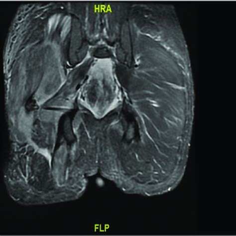 A Fasciotomy Incision Of The Gluteal Region The Patient Is In The Download Scientific Diagram