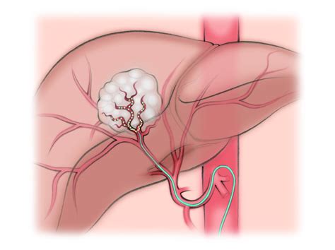 Transarterial Radioembolization “tare” — The Interventional Initiative