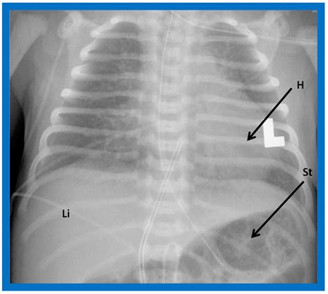 Diagnosis Of Dextrocardia With A Pictorial Rendition Of Terminology And