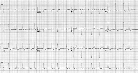 Digoxin Effect • Litfl • Ecg Library Toxicology