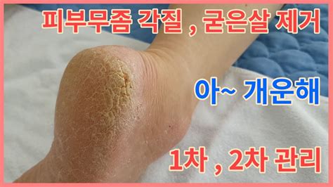 개운하게 지인의 피부무좀 발각질제거 뒤꿈치 굳은살 제거 하기 깔끔해져요 Youtube
