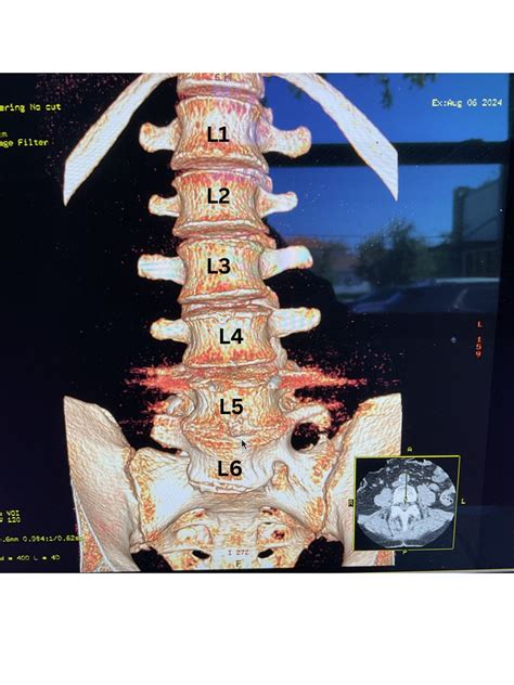 Arun Kalava Md Edra On Linkedin Lumbar 6 Bertolotti Syndrome 😍