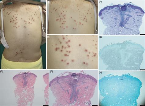 Figure 1 From Severe And Delayed Onset Acneiform Eruptions As An Adverse Reaction To Regorafenib