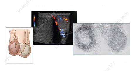 Testicular Torsion Imaging Illustration Stock Image C0593490