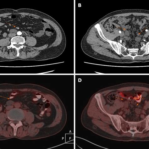 Contrast Enhanced Abdominal Pelvic Computed Tomography And Whole Body Download Scientific