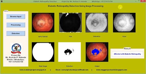 Diabetic Retinopathy Detection Matlab Project With Source Code ~ Low Price Projects