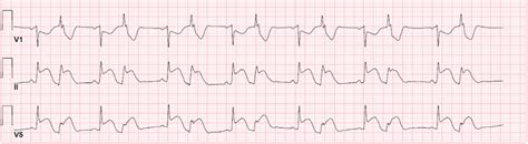Inferior Stemi Electrocardiogram In A Young Postpartum Female With Sickle Cell Trait With Chest