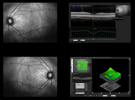 Understanding Oct Retinal Scan A Comprehensive Guide