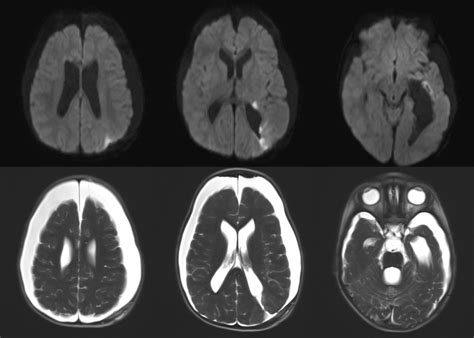 Choroid Plexus Papilloma Preoperative Embolization